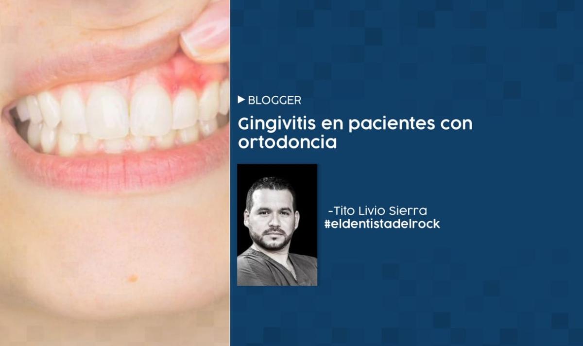 Gingivitis en pacientes con ortodoncia